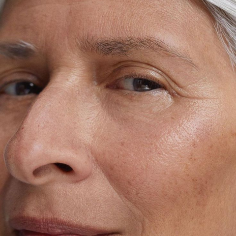 hyperkeratinization causes